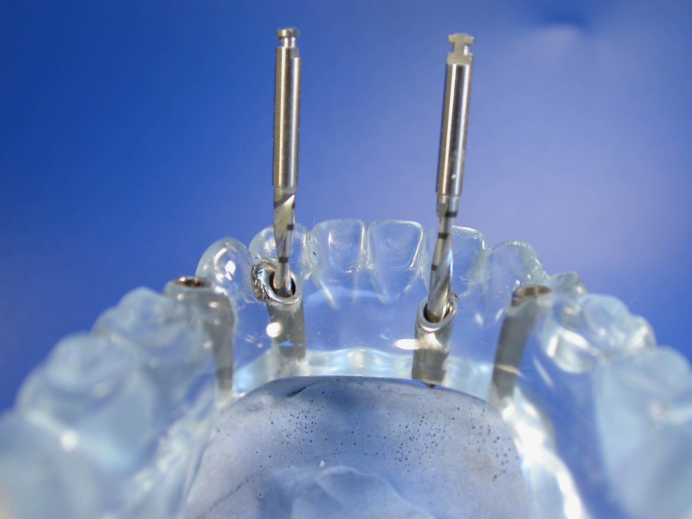 Implantologie – Goedegebuure Tandtechniek