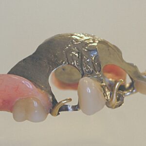 Frame prothesen – Goedegebuure Tandtechniek